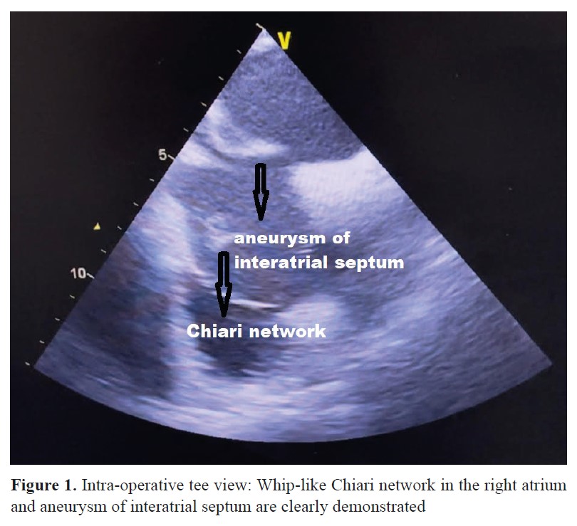 Evaluation of inflammation with CRP, Pro-BNP, Leptin and Pentraxin-3 ...